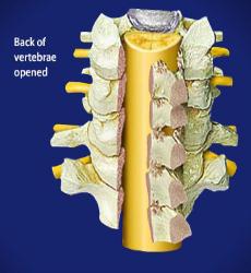 Page 2 - Laminoplasty